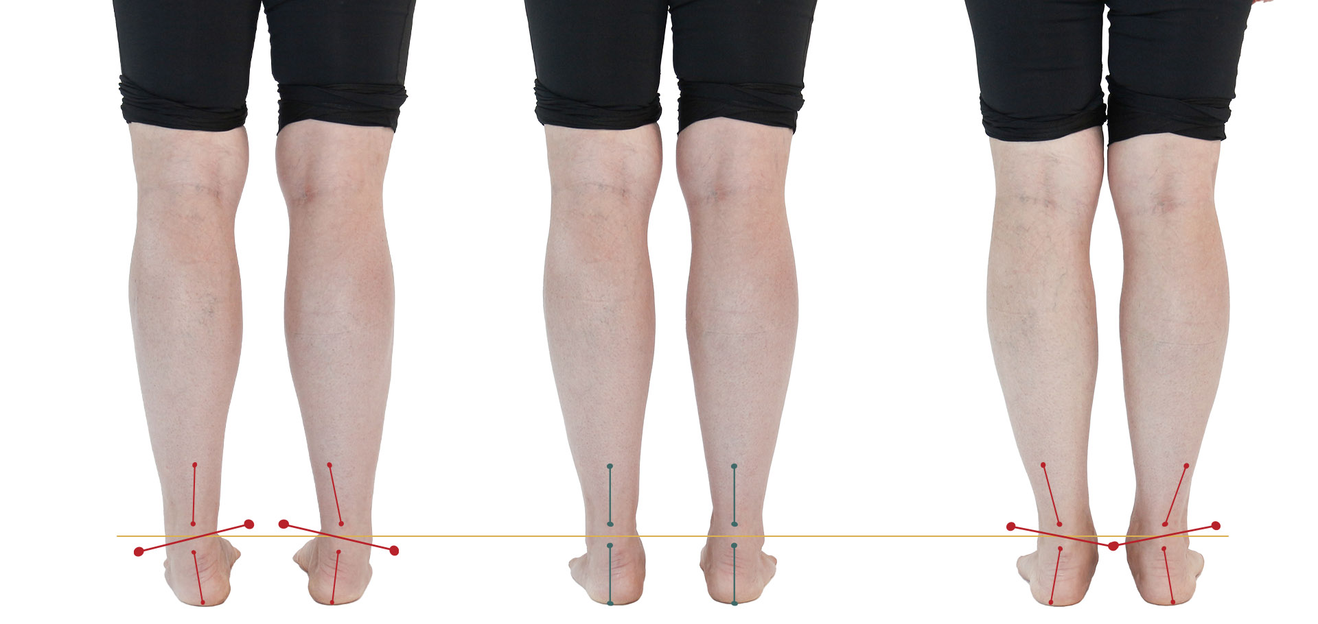 L'alignement statique des jambes en position debout - PosturAction